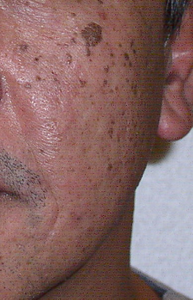 Squamous Cell Carcinomas and Keratosis: Verruca Seborrheica Keratosis