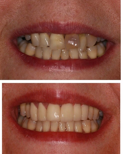 Getting Your Teeth Capped With Dental Crowns ~ Dental Crown Delhi