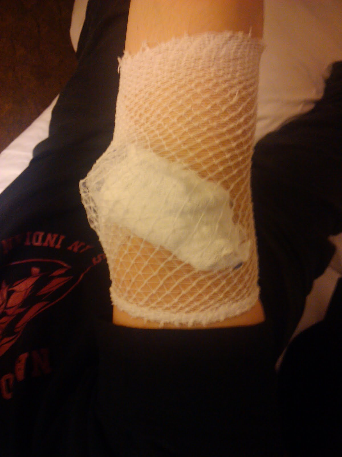 Moon's Big C Journey: PICC LINE for first chemo treatment! (1/17/2011 ...