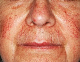 ageless beauty, timeless skin: Couperose Skin explained