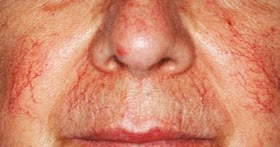 ageless beauty, timeless skin: Couperose Skin explained