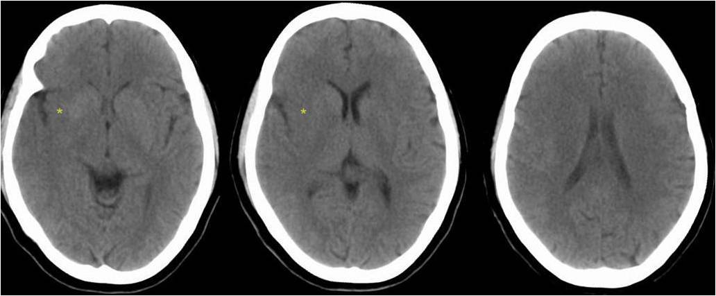 Dr Balaji Anvekar FRCR: Imaging in Acute Ischemic Stroke