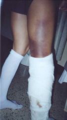 The Road Back to Running: Shattered Leg, Shattered Dreams