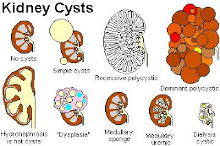 treatment for kidney disease: Common Senses for Bilateral Renal Cyst