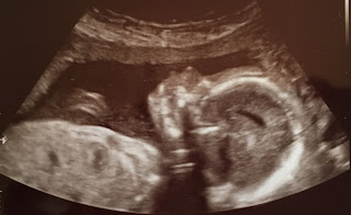 Emotional Healing from Cesarean