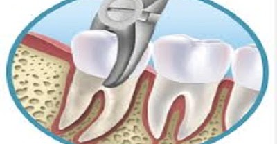 bridge teeth: Simple and Surgical Extractions