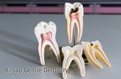 Kitsap Gentle Dentistry: Root Canals and Cancer
