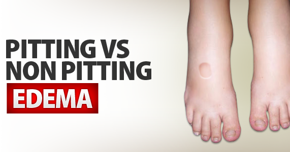 Oedema