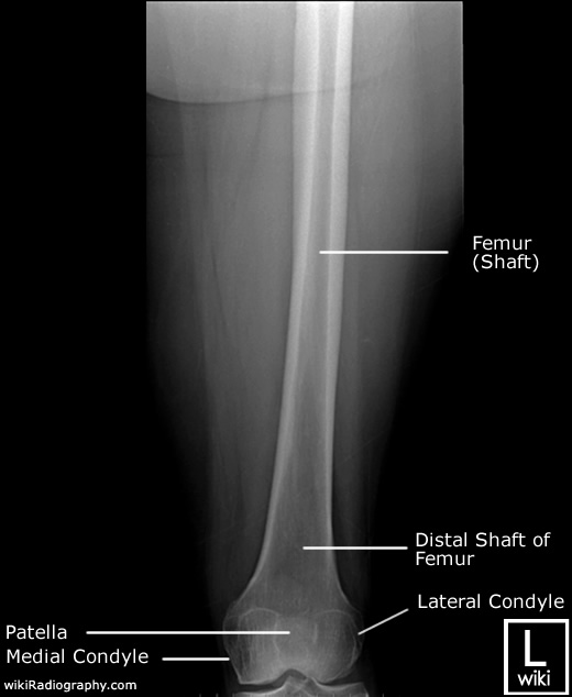 TEKNIK RADIOGRAFI FEMUR - Radiografer