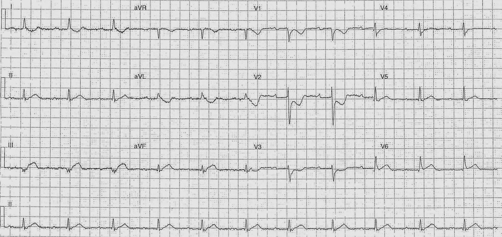 ECG of the Week: ECG of the Week - 8th September 2014 - Interpretation