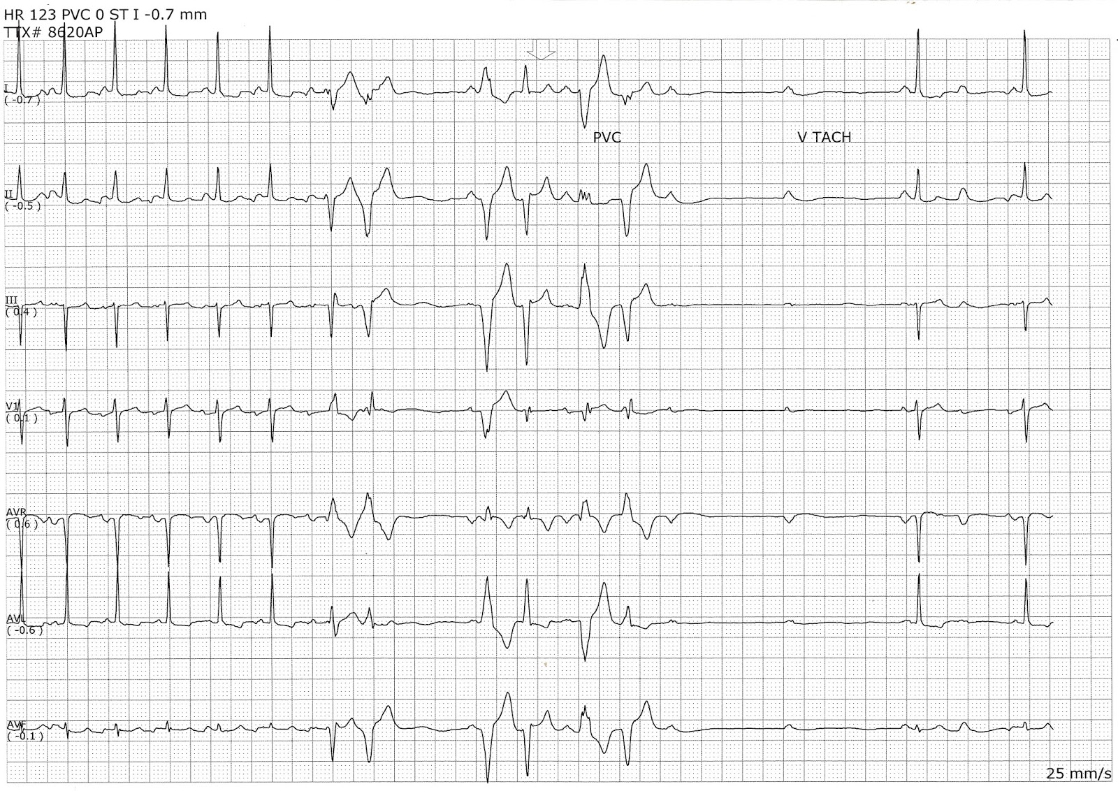 Sinus rhythm with multifocal PVCs and non-conducted P waves
