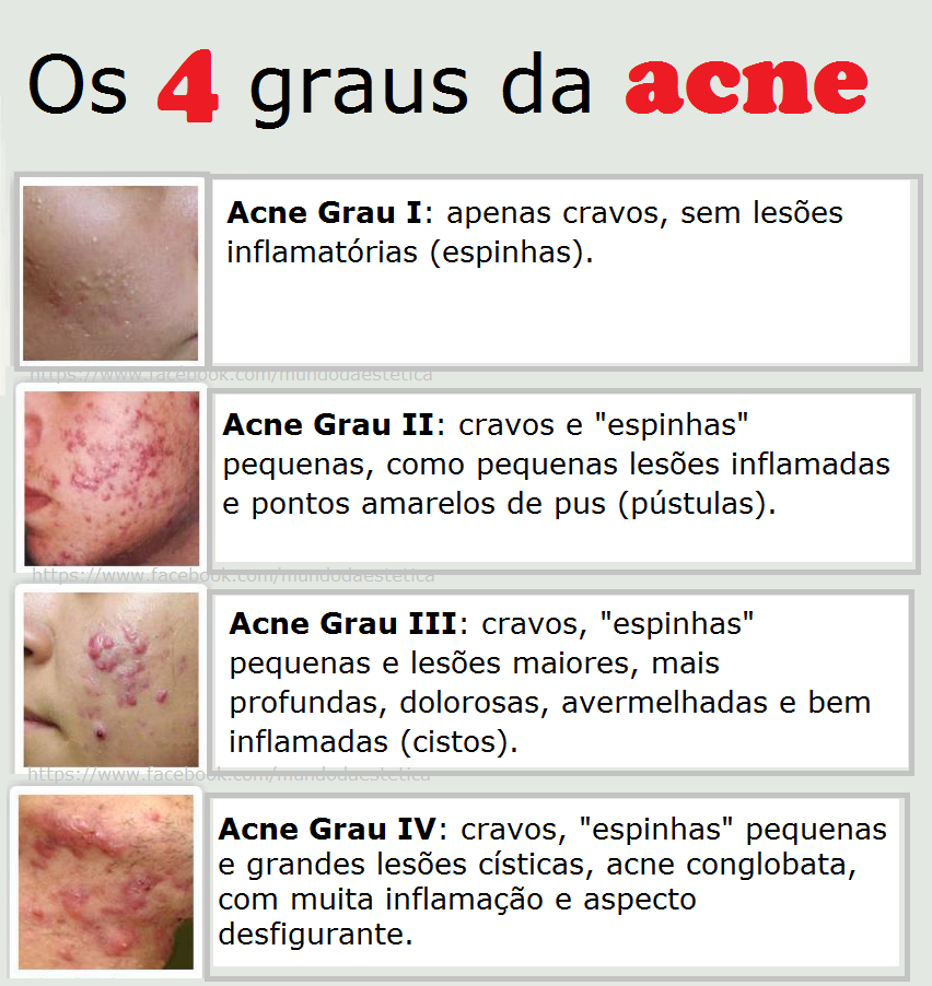 Pele Acneica: ACNE E SEUS GRAUS