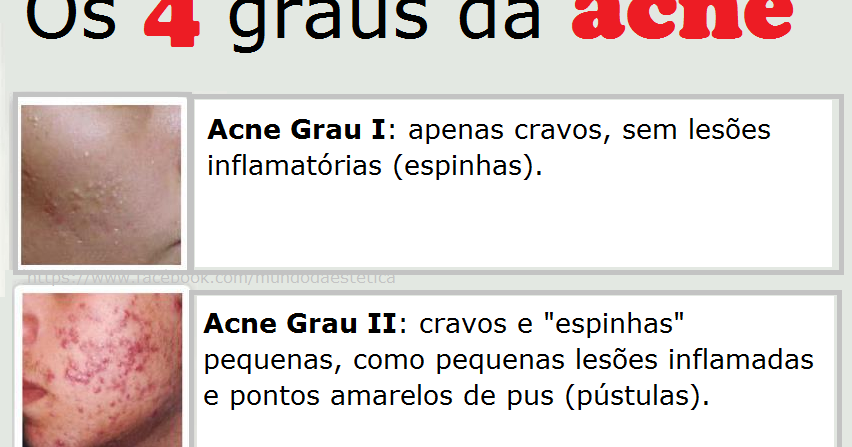 Pele Acneica: ACNE E SEUS GRAUS