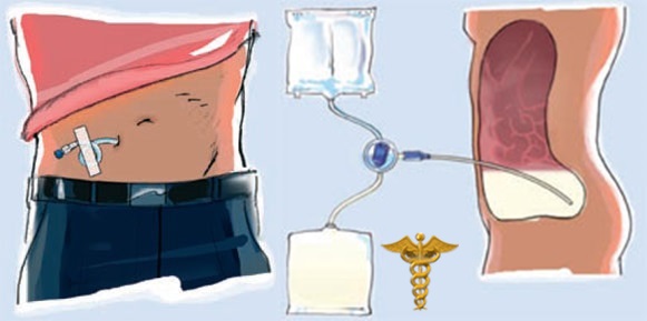 PERİTON DİYALİZ YAPTIĞIM DÖNEM...