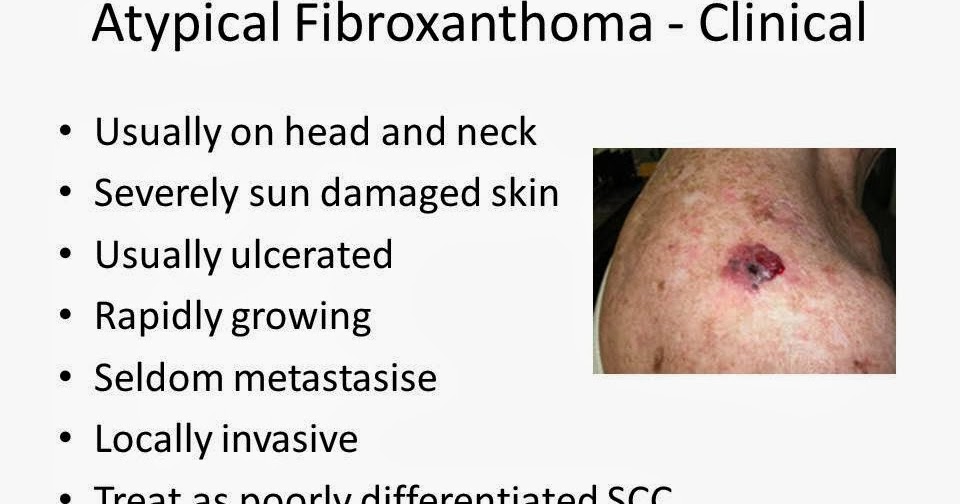 Dermpath Made Simple - Neoplastic: Atypical Fibroxanthoma