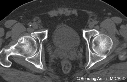Roentgen Ray Reader: Fat within the Urinary Bladder Wall