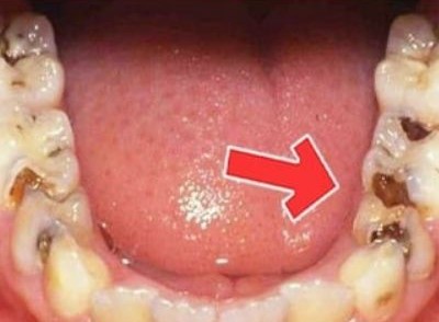 How to Heal Cavities and Tooth Decay Naturally with These Home Remedies ...