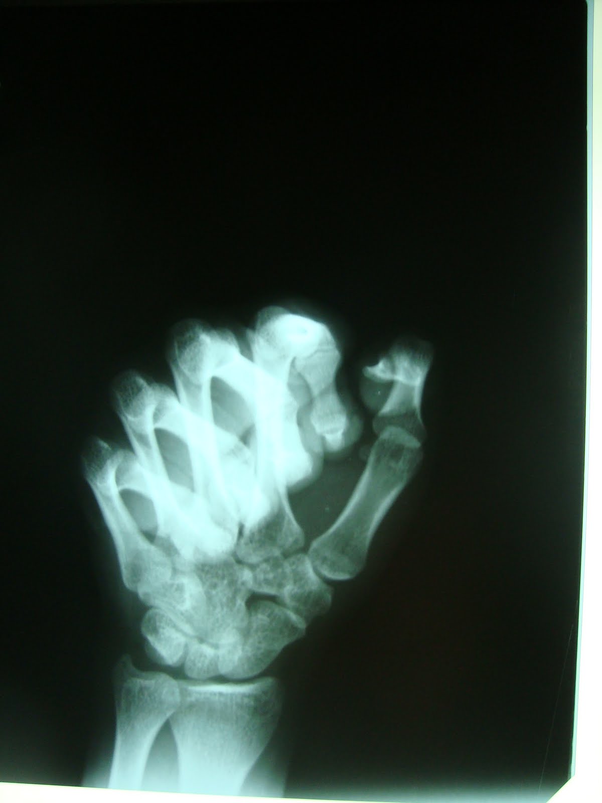 RADIOLOGIA 1: Mano. proyección oblicua. Nota: Kallen
