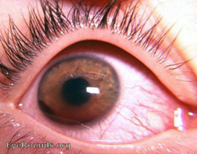 Blood In The Eye: Managing Hyphema - Eyedolatry