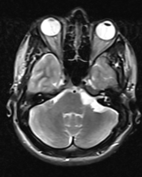 Cerebellopontine Angle Epidermoid-MRI - Sumer's Radiology Blog