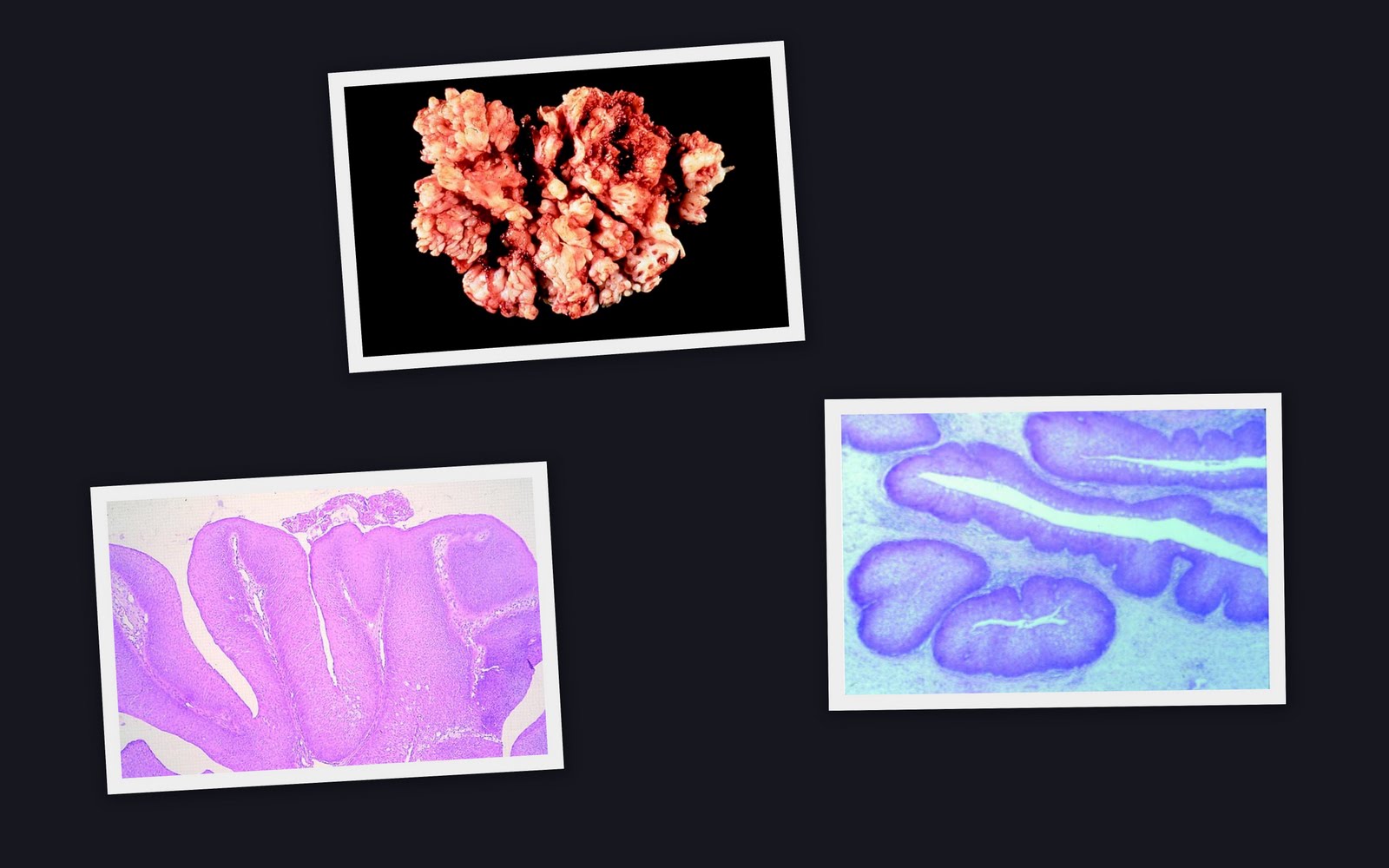 Update : Schneiderian papillomas