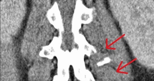 My herniated and degenerated lumbar disc journey.: Visit to Orthopedic ...