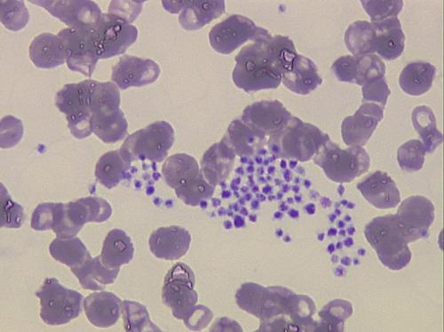 Thrombopénies - BIOLOGIE MEDICALE