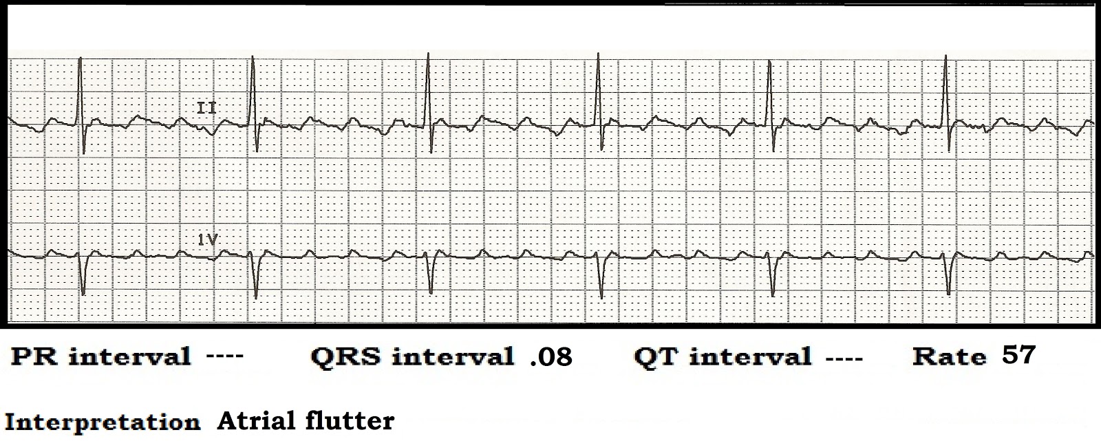 ECG Rhythm Strip Quiz 81: Interval measurements