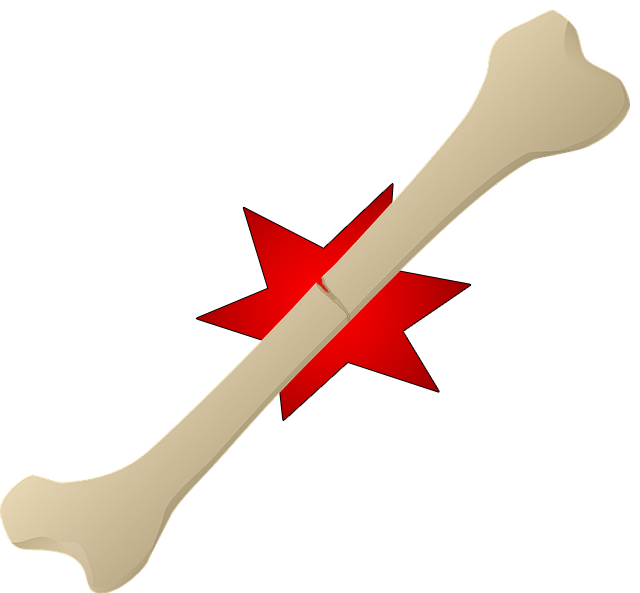 Fracturas: generalidades, clasificaciones, complicaciones, y manejo ...