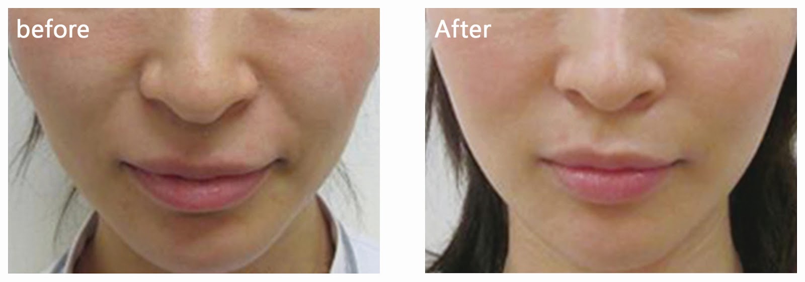 Shinagawa Introduces Reign Lift and 3D Angel Lift in the Philippines ...