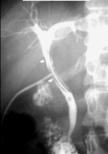 Exames Contrastados - COLANGIOGRAFIA