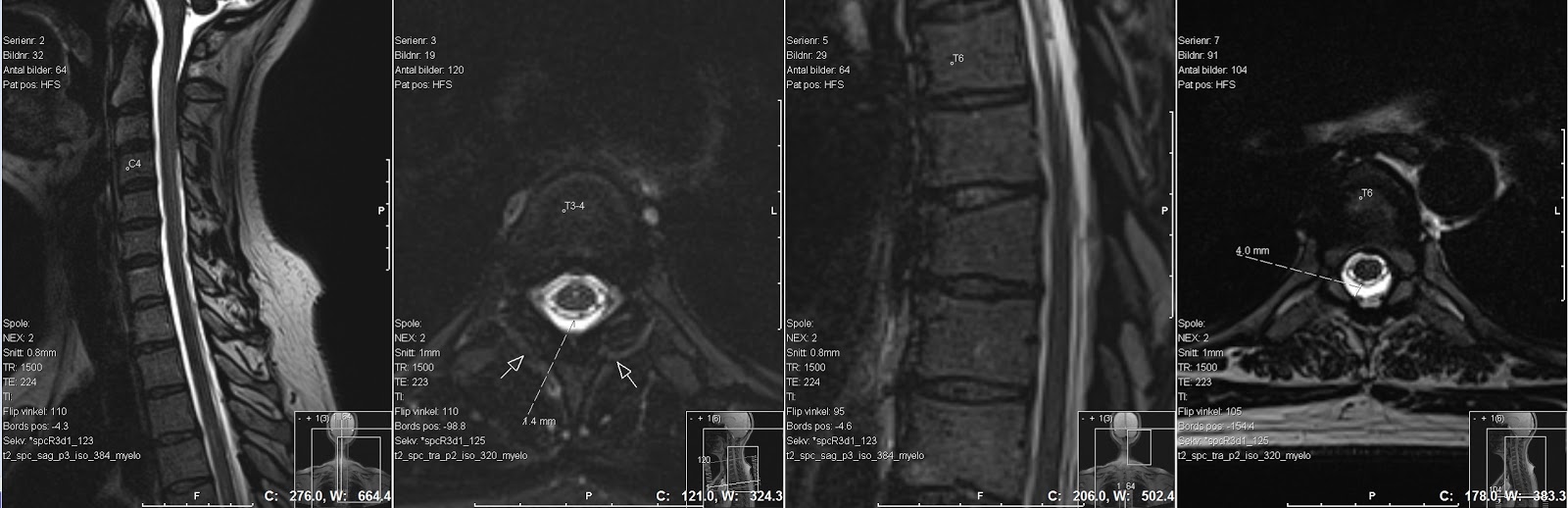 CSF Leakage Spine - MRI Protocol