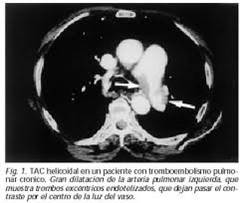 médicos latinos : TROMBOEMBOLISMO PULMONAR (TEP)