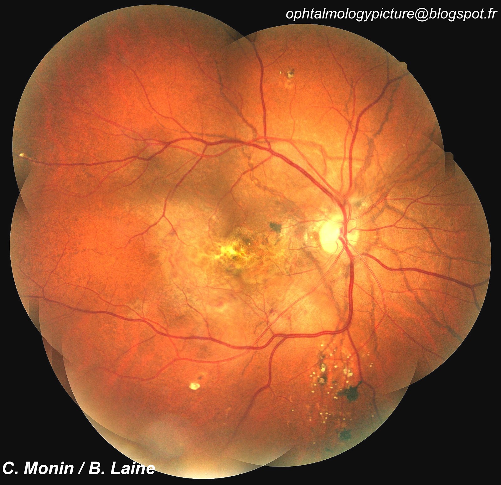 ophtalmologypicture: Stries angioïdes