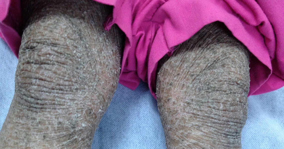 VIRTUAL GRAND ROUNDS IN DERMATOLOGY 2.0: Congenital Ichthyosis in an ...