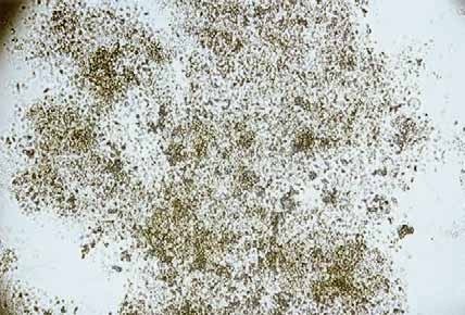 [Haematology] Microscopic Examination of Urinary Sediment - Crystals ...