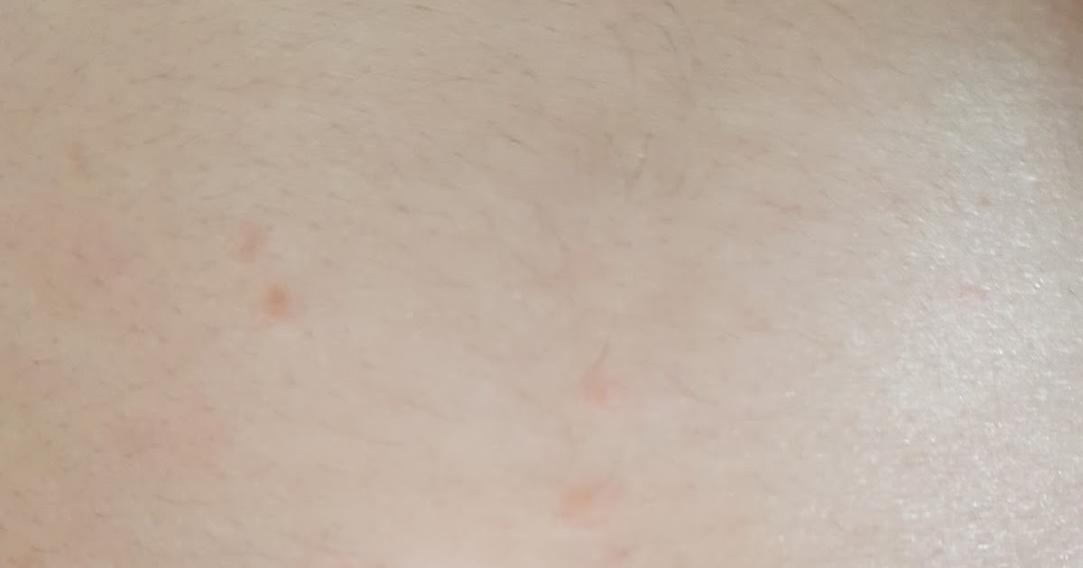 Patricia's story to tell: PUPPP - Skin rash due to pregnancy (in Bahasa ...