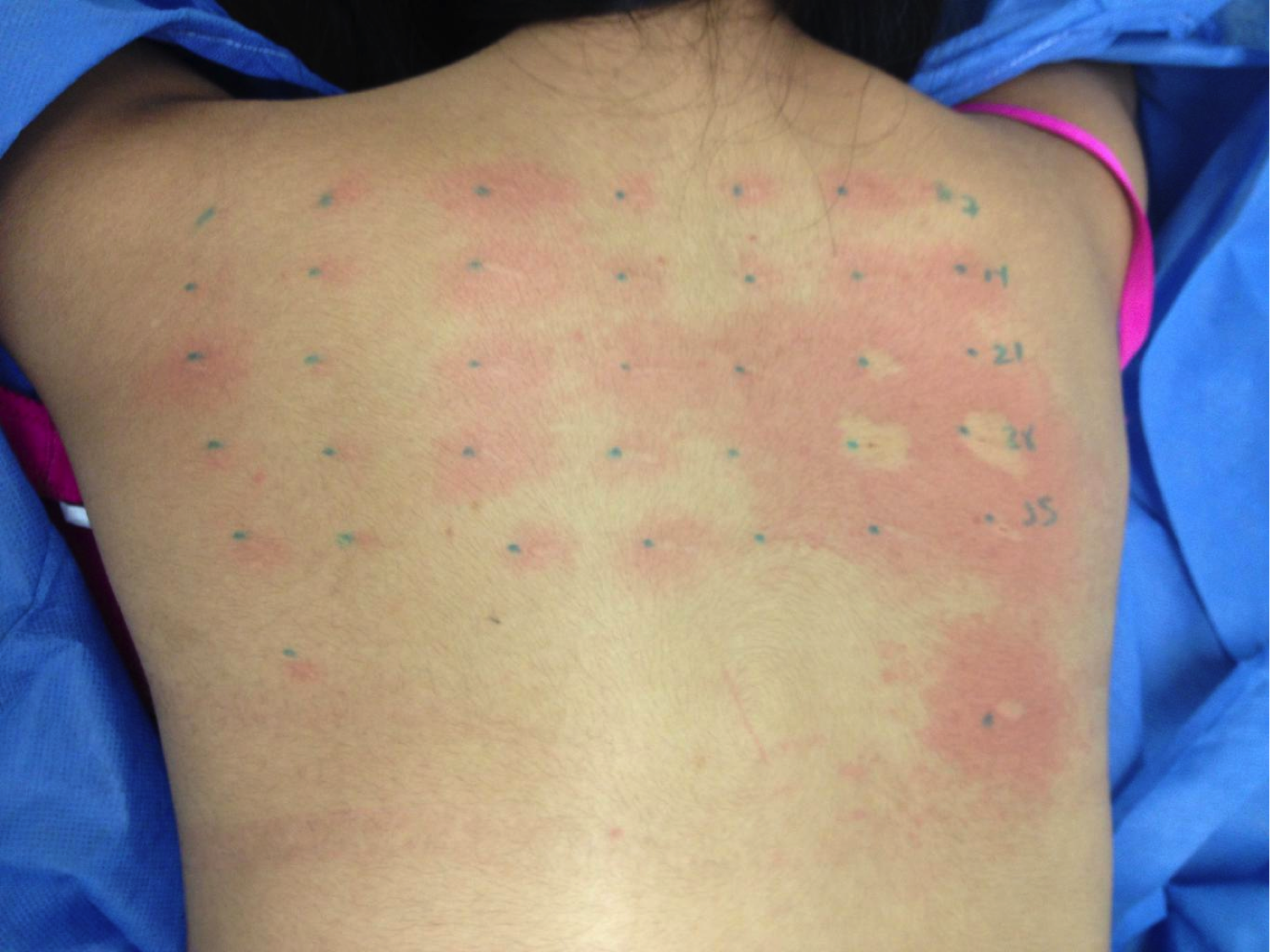 Asma+Alergia Monterrey: Pruebas cutáneas