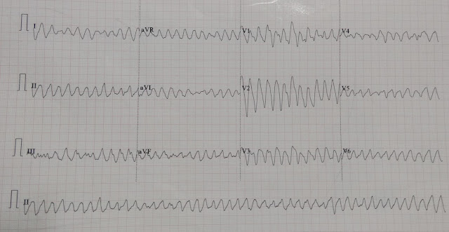 Cardiology window: Ventricular flutter in a patient with anterior wall ...