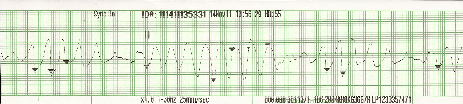ECG Rhythm Strip Quiz 85: Electrical interventions