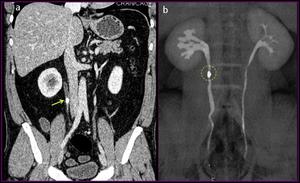 El problema de la Dosis de radiación en la URO TC (por Miguel Ángel de ...