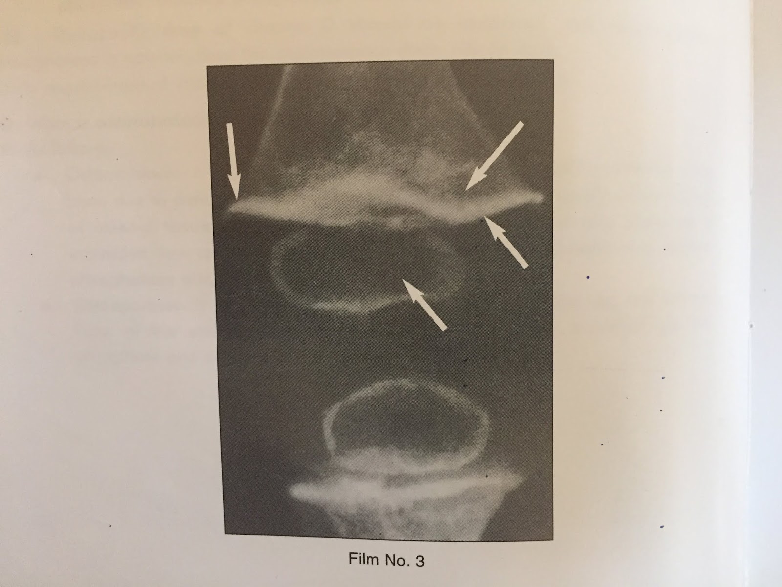 XRAY OF SCURVY DISEASE