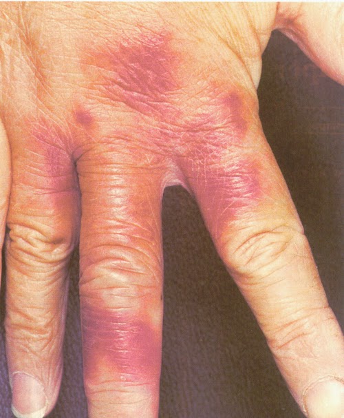 Dr Sherazi: Erysipelas