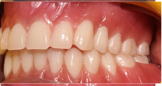 Understanding Prosthodontics - Tagore Dental College & Hospital-By ...