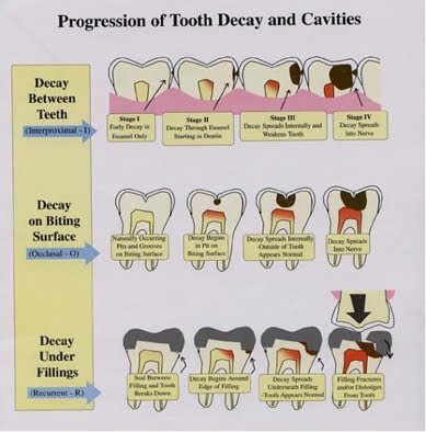www.BestOgdenDentist.com Blog: Progression of tooth decay