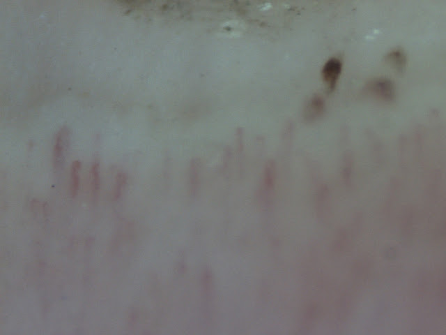 Rheumatologe: Trophic disturbance in nail growth