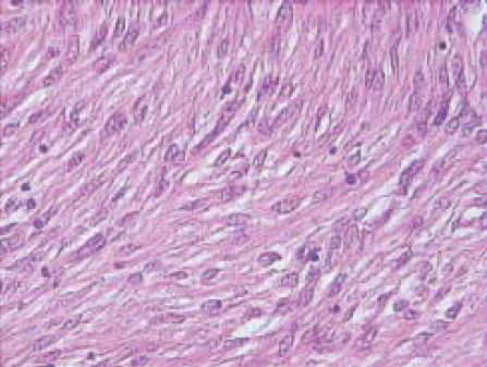 Leiomiosarcoma: leiomiosarcoma