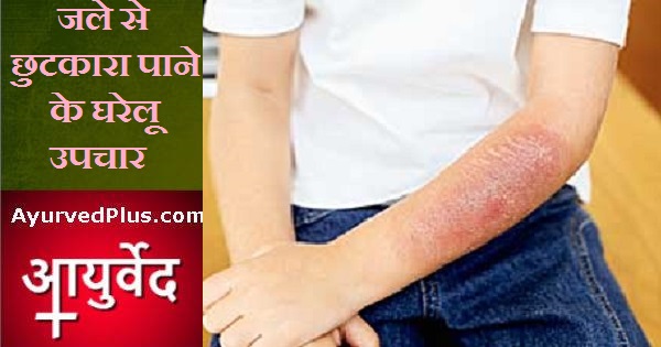 जले से छुटकारा पाने के 10 घरेलू उपचार आयुर्वेदप्लस