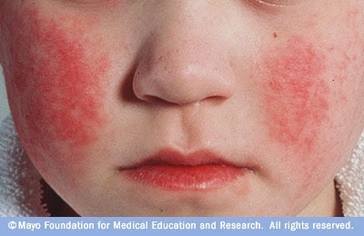 Enfermedades Exantemáticas - Eritema Infeccioso o Quinta Enfermedad ...