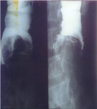 Intussusception Claw Sign Gastrointestinal Imaging | Radiology Key
